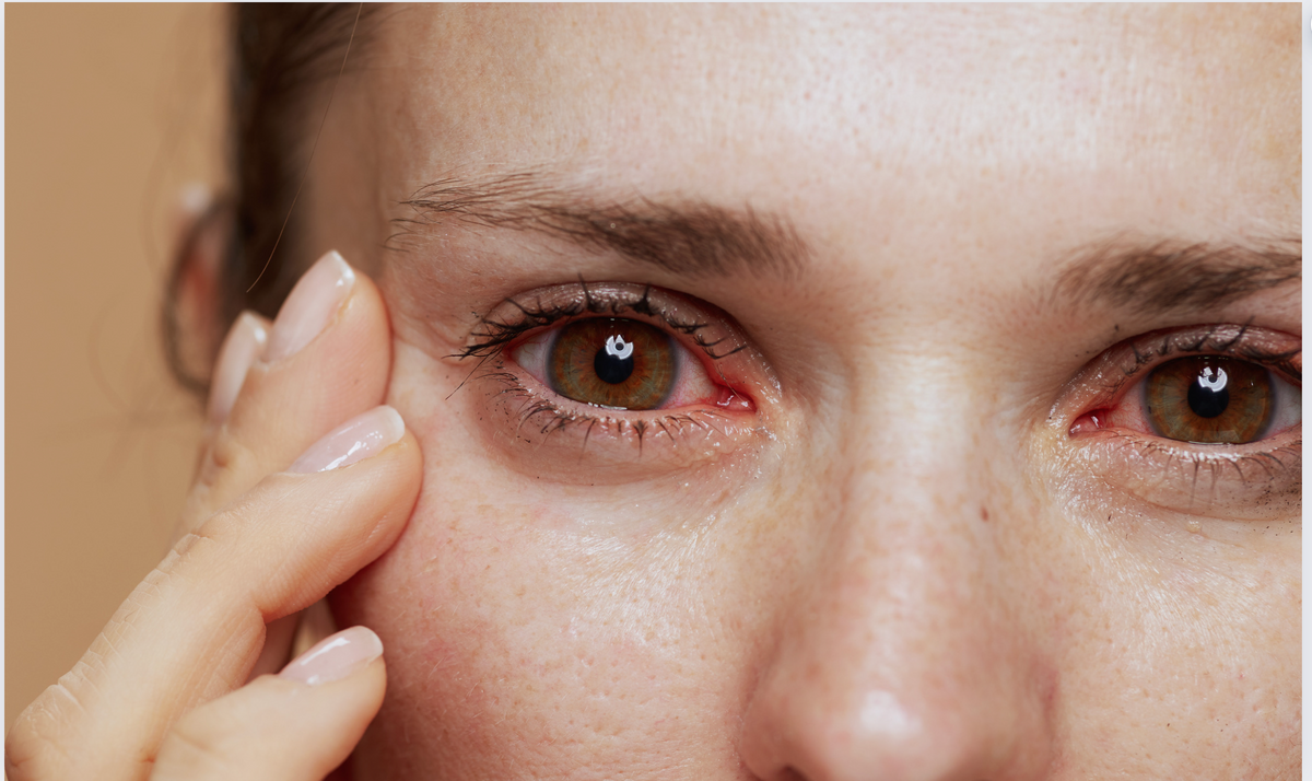 How to Get Rid of Red Eyes - CHome Remedies & Tips for Prevention – Adasat